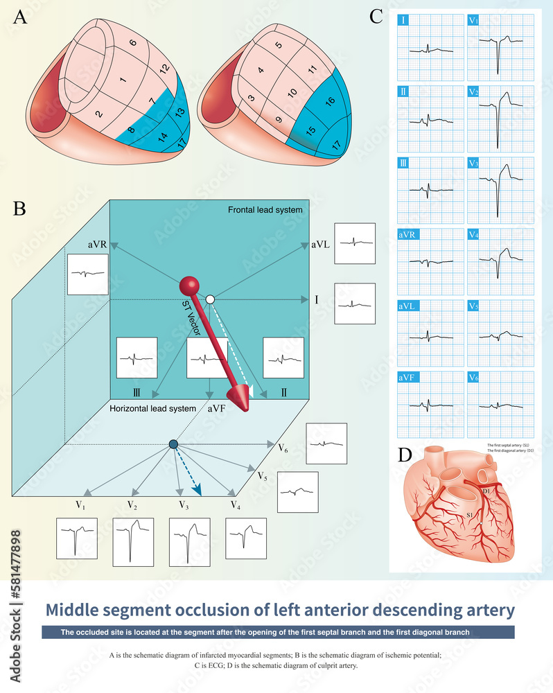 When the middle - distal segments of the LAD were occluded, the ...