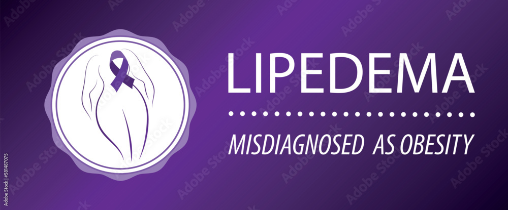 Lipedema awareness concept banner. Support lipedema concept Stock ...