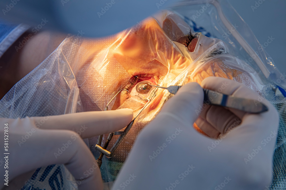 Laser vision correction. A patient and team of surgeons in the ...