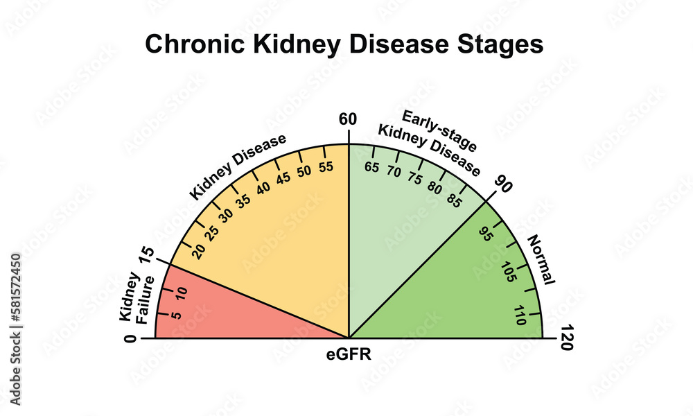 Scientific Designing of Chronic Kidney Disease (CKD) Stages. Vector ... Scientific Designing of Chronic Kidney Disease (CKD) Stages. Vector ...