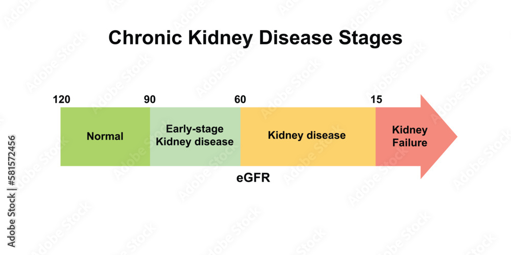 Scientific Designing of Chronic Kidney Disease (CKD) Stages. Vector ... Scientific Designing of Chronic Kidney Disease (CKD) Stages. Vector ...