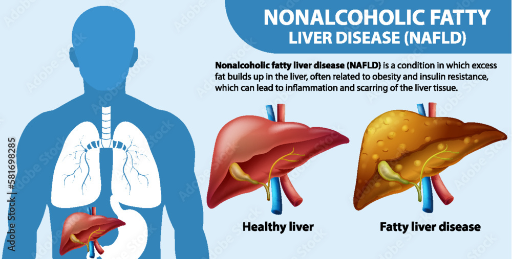 Nonalcoholic Fatty Liver Disease (NAFLD) Stock Vector | Adobe Stock