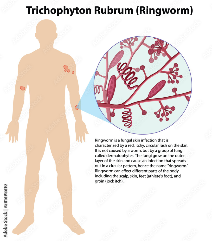 Trichophyton Rubrum fungal infection Stock Vector | Adobe Stock
