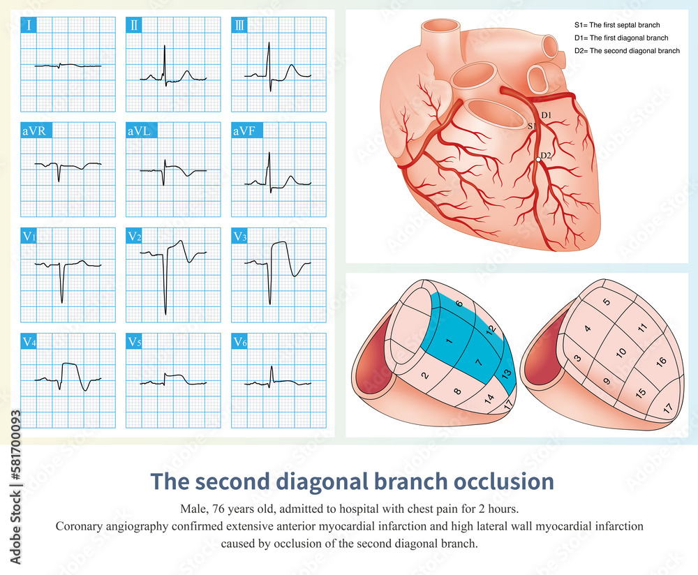 When the second diagonal branch of the LAD is occluded, it causes a ...