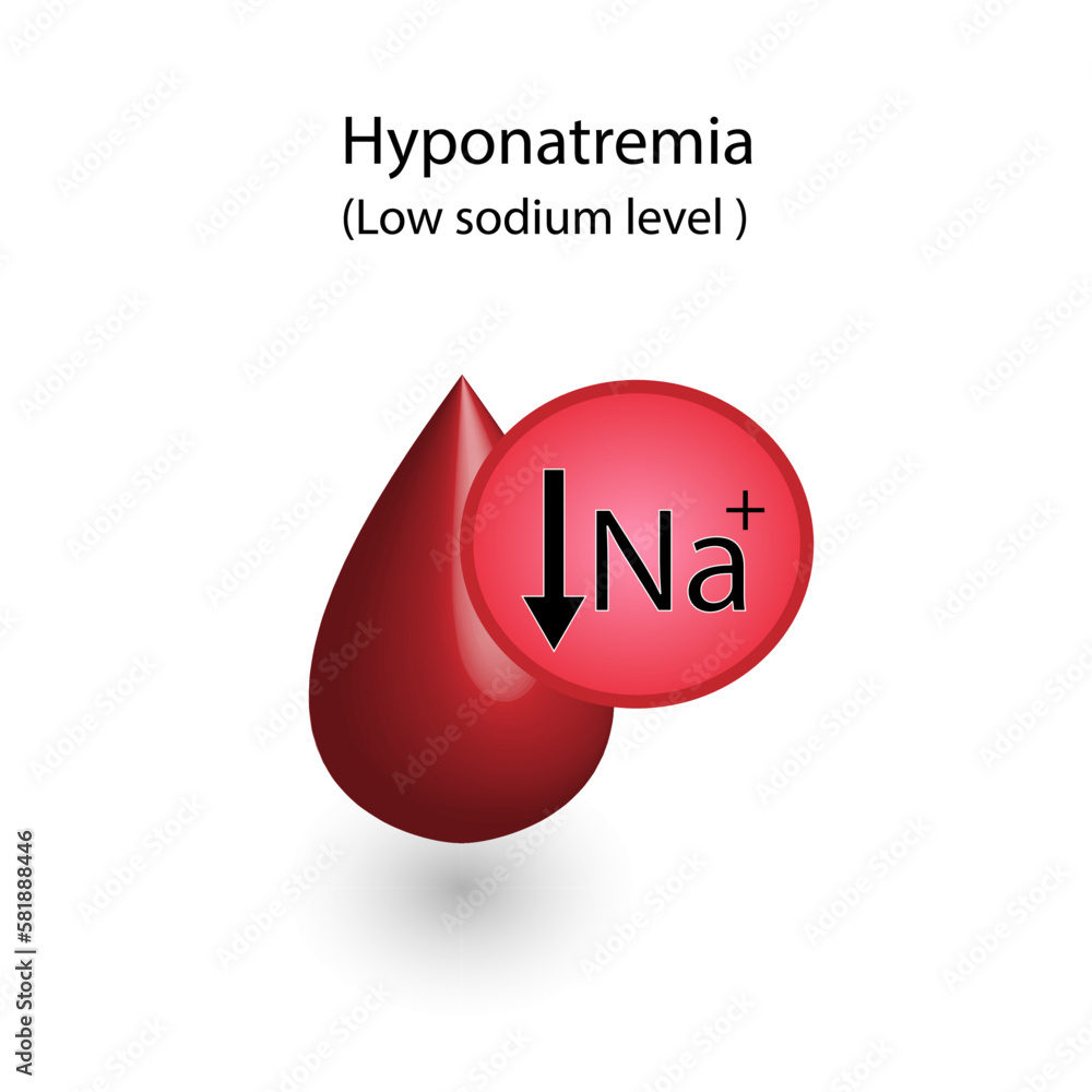 Hyponatremia, low plasma sodium level. Sodium Na excess and deficit ...