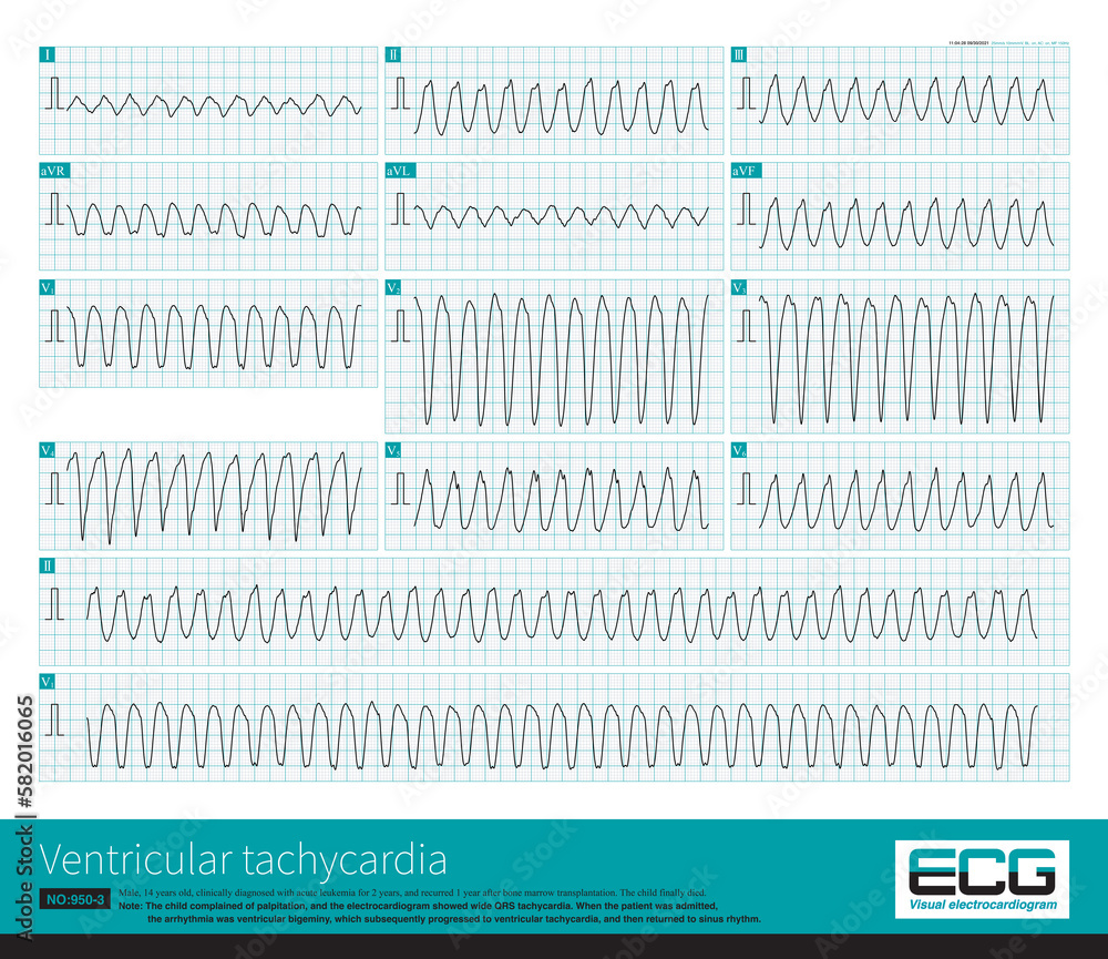 A 14-year-old leukemic child had a sudden wide QRS tachycardia with a ...
