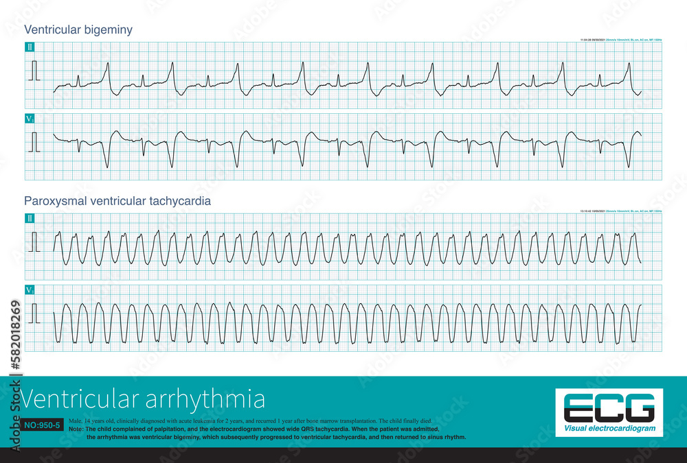 A 14-year-old leukemic child had a sudden wide QRS tachycardia with a ...