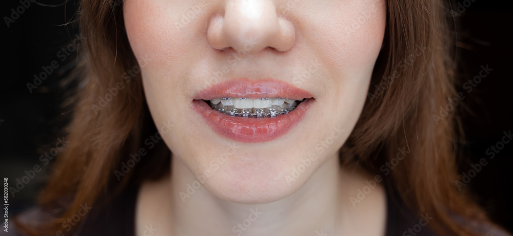 The smile of a young and beautiful girl with braces on her white teeth ...