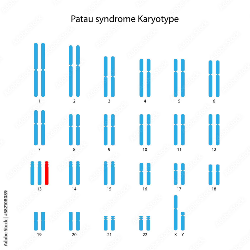 Patau syndrome (trisomy 13) human (male) karyotype Stock Illustration ...