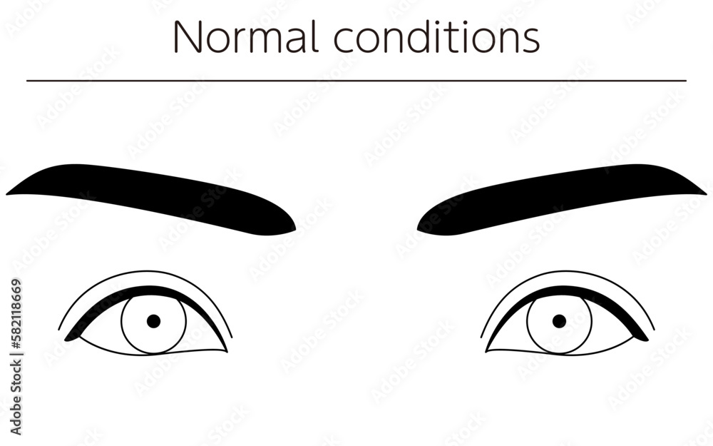 Medical illustrations, diagrammatic line drawings of eye diseases ...