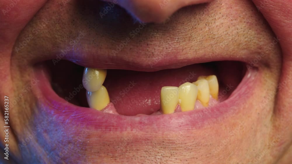 Periodontal disease and missing teeth in an elderly man. Close up shot ...