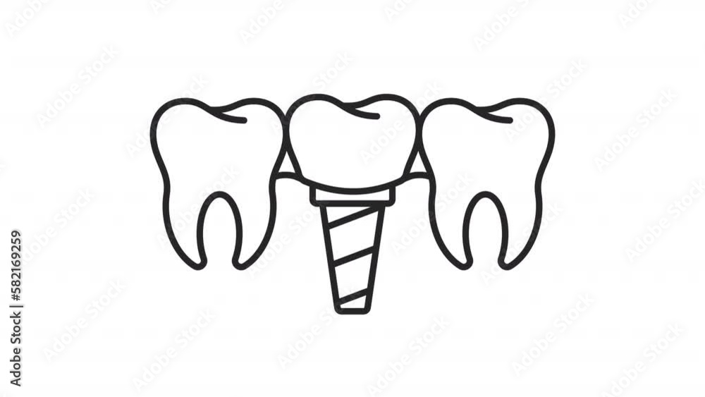 Animated prosthesis linear icon. Endosseous implant. Dental surgery ...