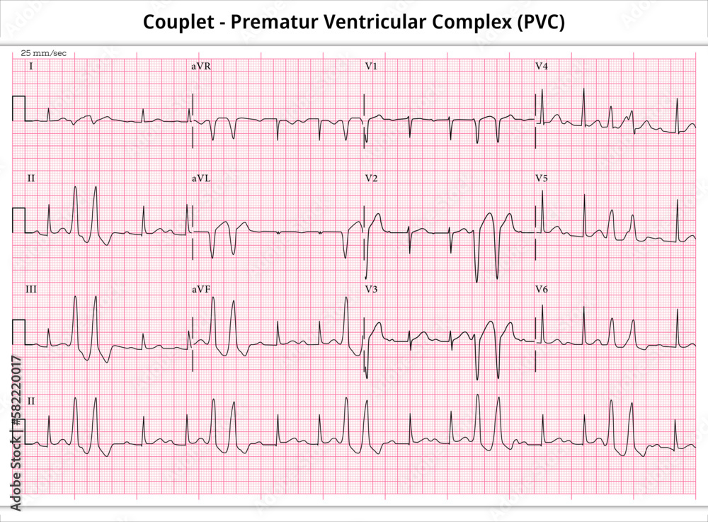 Couplet - Premature Ventricular Complex (PVC) - Ventricular Premature ...