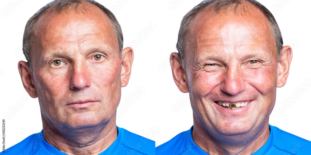 Serious and laughing face of an adult man with gold teeth close-up ...