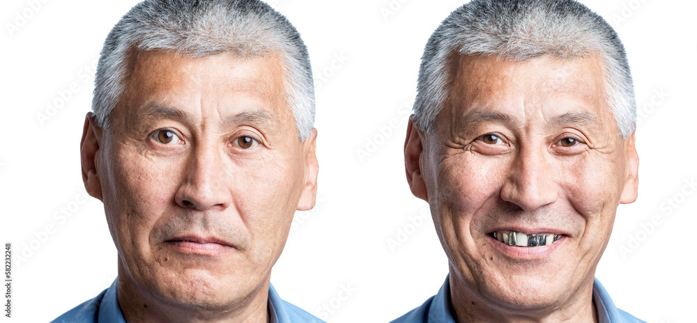 Serious and laughing face of an adult man with gold teeth close-up ...