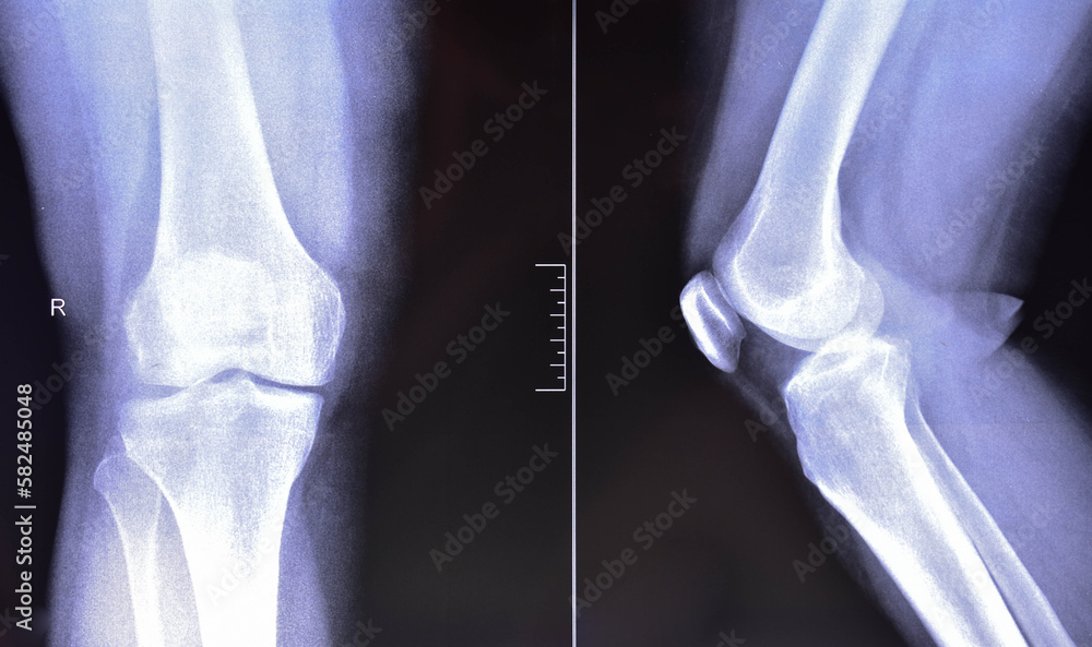 X-ray of the knee joints, an image of the knee bones on an X-ray. Stock ...
