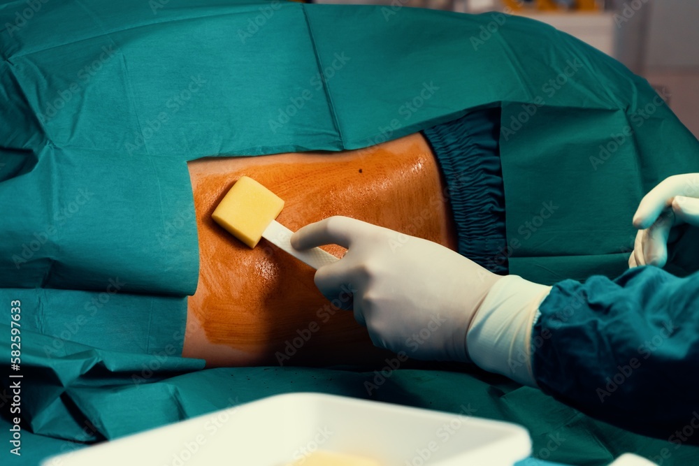 Doctor or surgeon apply betadine to the patient for anesthesia ...