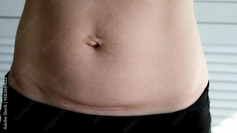Video „Abdomen of woman after the child birth by Cesarean section. Scar ...