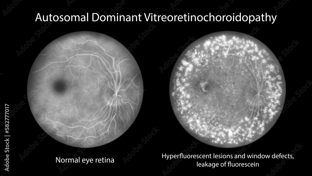 Autosomal dominant vitreoretinochoroidopathy, illustration showing ...