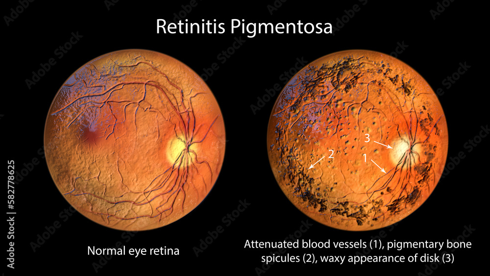 Retinitis pigmentosa, a genetic eye disease leading to vision loss. 3D ...