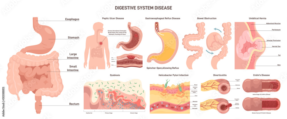 Digestive system diseases set. Gastroenterology disorder, internal ...