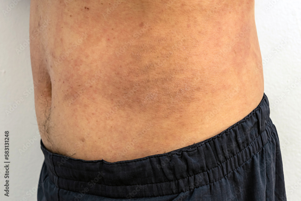 Itchy body rash caused by allergies on middle part of man body. Male ...