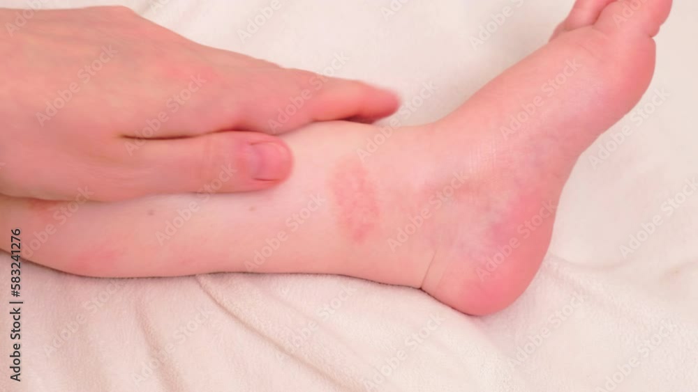 Toddler baby skin care, allergies and dermatitis. A mother woman smears ...