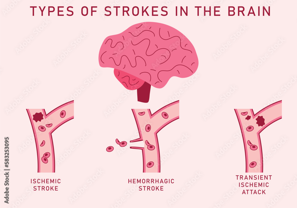 Types of strokes in the brain. Transient ischemic attack, Stock Vector ...