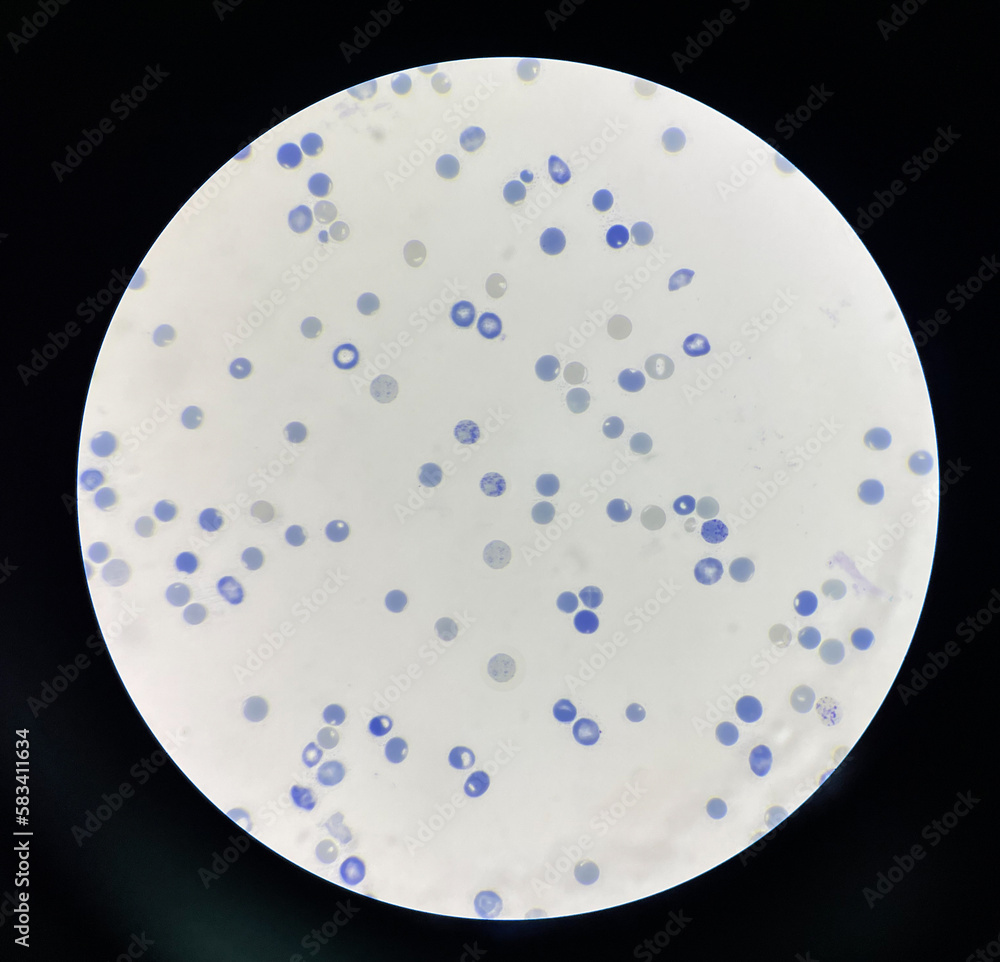 Reticulocytes are red blood cells that are still developing. Stock ...