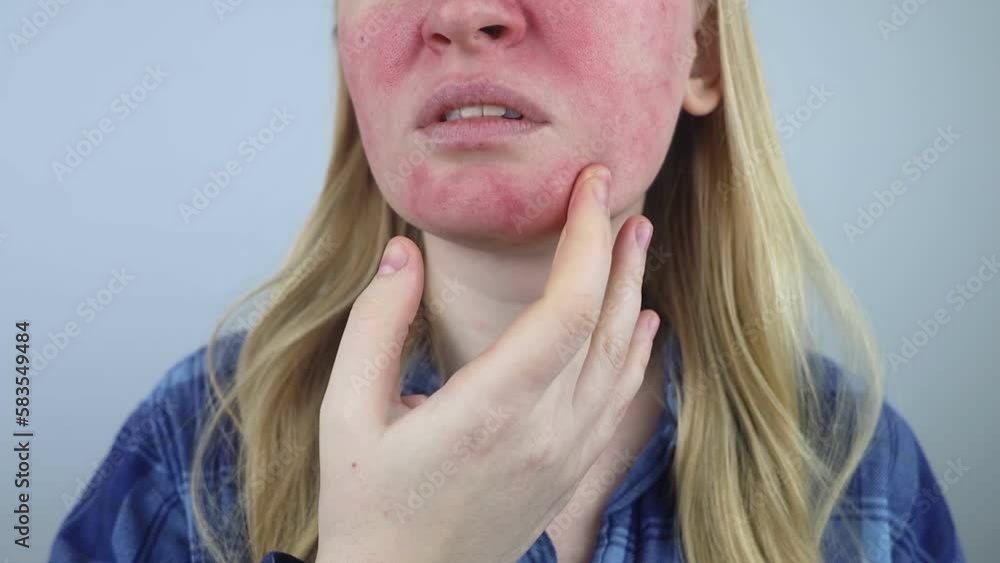 Rosacea face. The girl suffers from redness on her cheeks. Couperosis ...