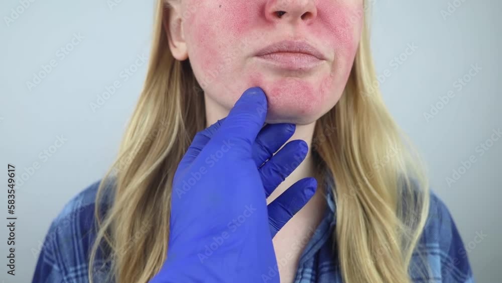 Rosacea face. The girl suffers from redness on her cheeks. Couperosis ...