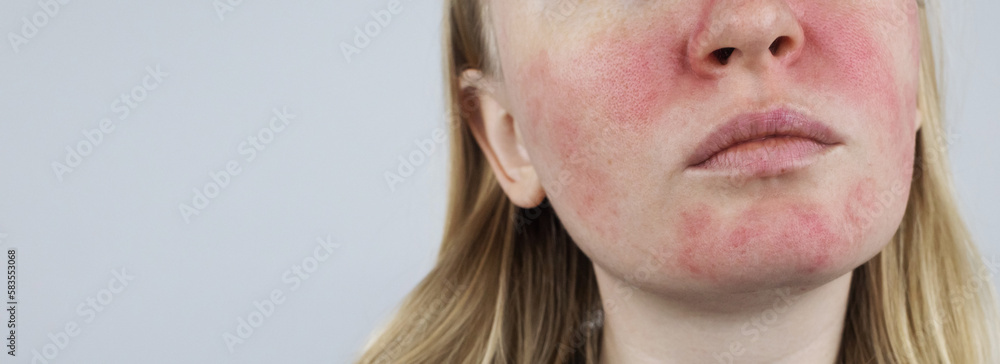 Rosacea face. The girl suffers from redness on her cheeks. Couperosis ...