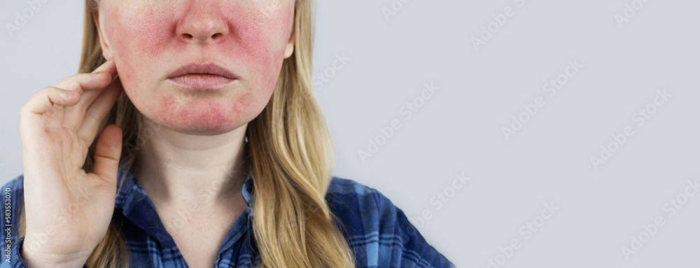 Rosacea face. The girl suffers from redness on her cheeks. Couperosis ...
