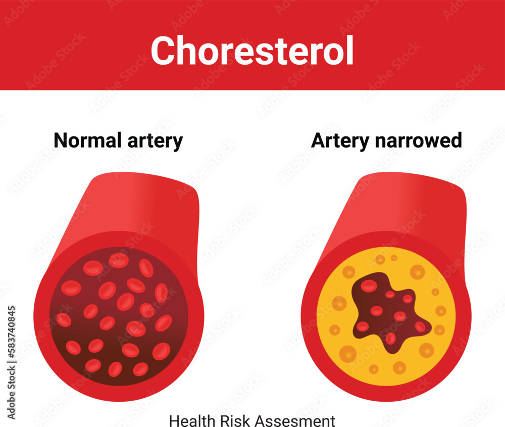 Normal blood vessel versus artery with cholesterol plaque vector Stock ...
