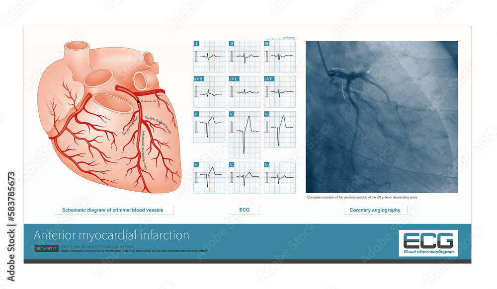 The proximal occlusion of the left anterior descending artery leads to a large area of anterior ...