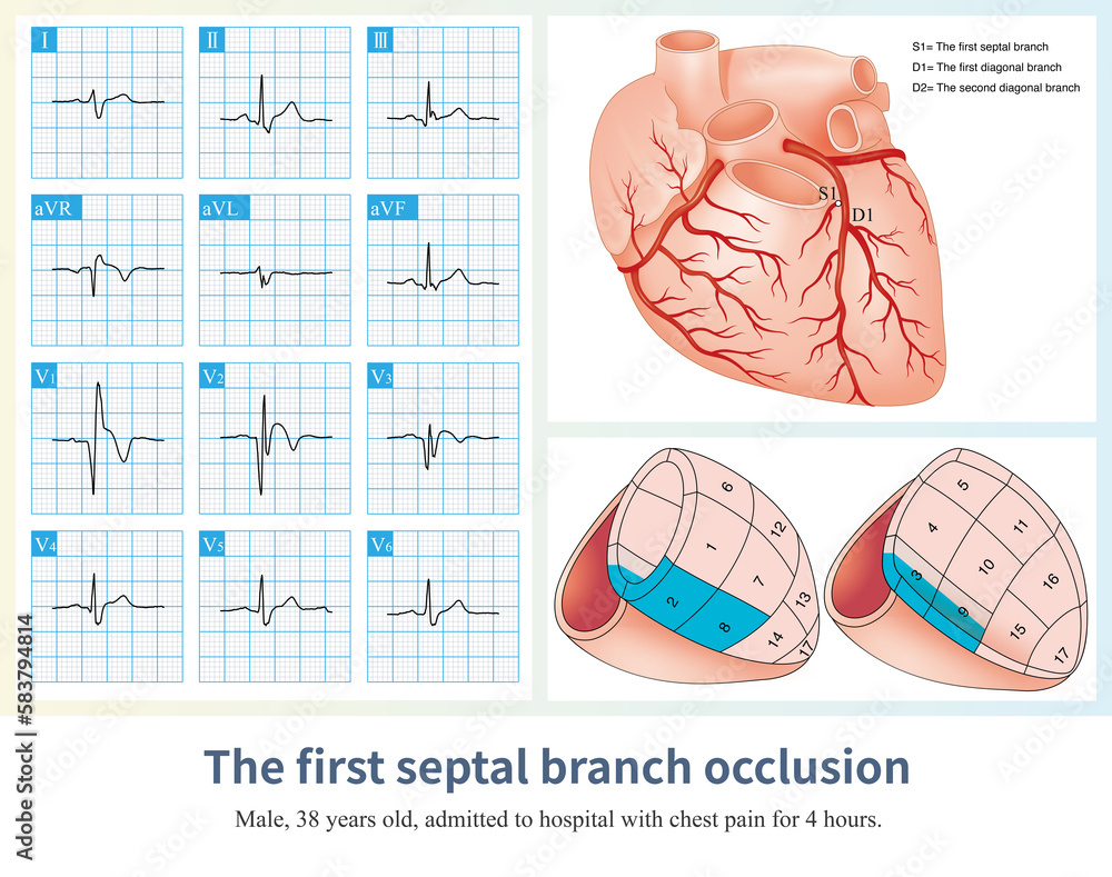 When Isolated First Septal Branch Occlusion Occurs It Causes Acute Anteroseptal Myocardial