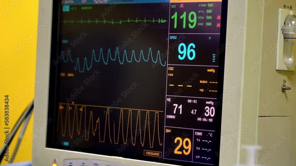 Operation. the work of the patient's heart is broadcast on the monitor ...