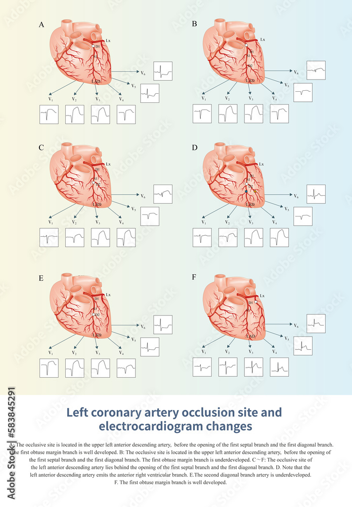 When different parts of the left coronary artery are occluded, it can lead to ST segment ...