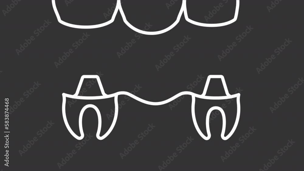 Animated bridge white line icon. Artificial teeth. Dental procedure ...