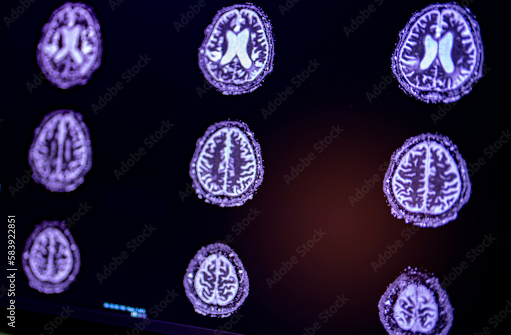 The imaging of advanced MRI. DWI diffusion weighted image phase. Stock ...