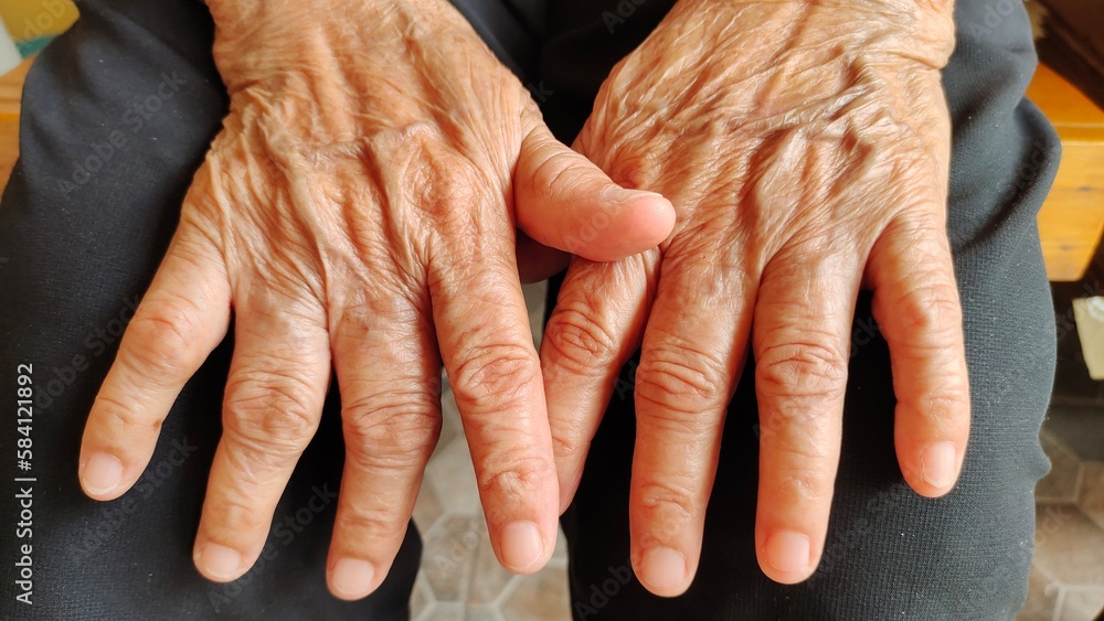 portrait showing the wrinkle and blood spider veins on the hands of the ...