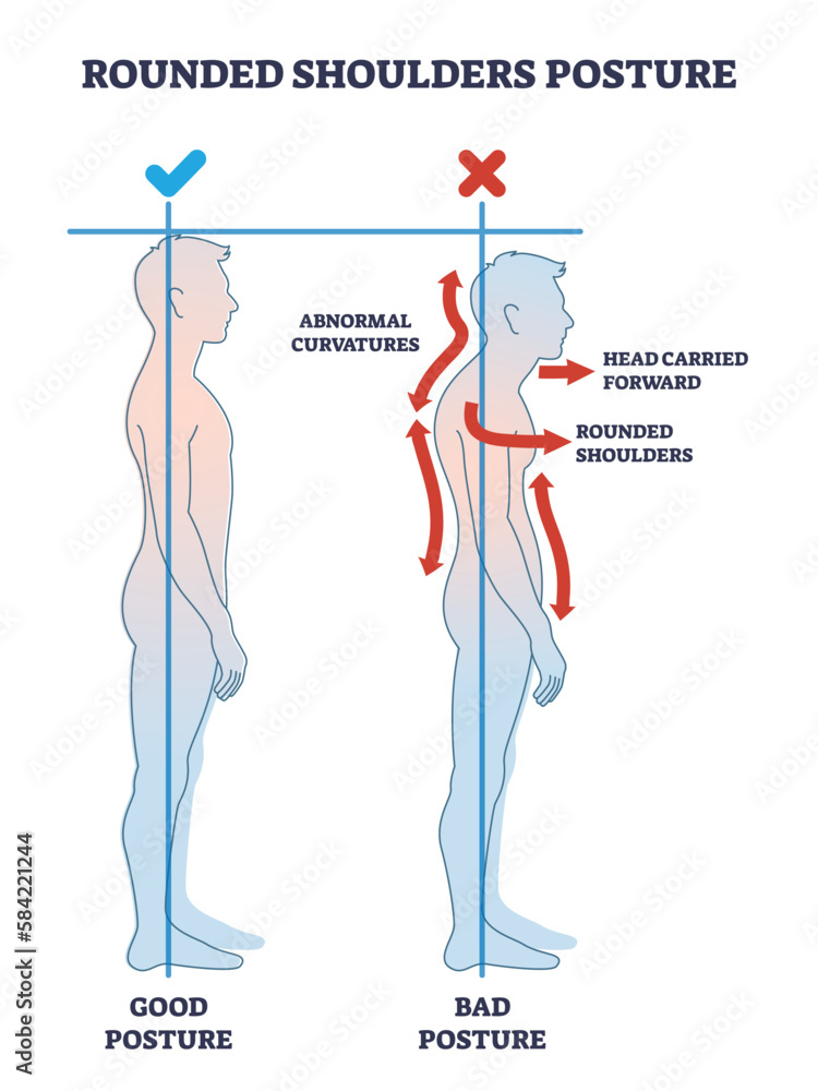 Rounded shoulders posture with body alignment forward outline diagram ...