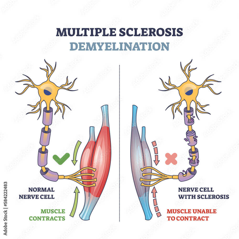 Vettoriale Stock Multiple sclerosis demyelination compared with medical ... Vettoriale Stock Multiple sclerosis demyelination compared with medical ...