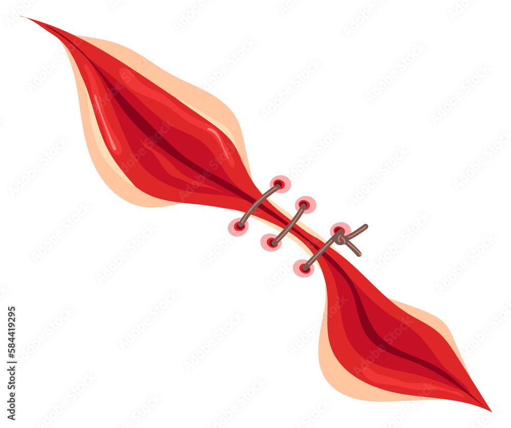 Skin cut wound with surgical stitches. Red mark Stock Illustration ...