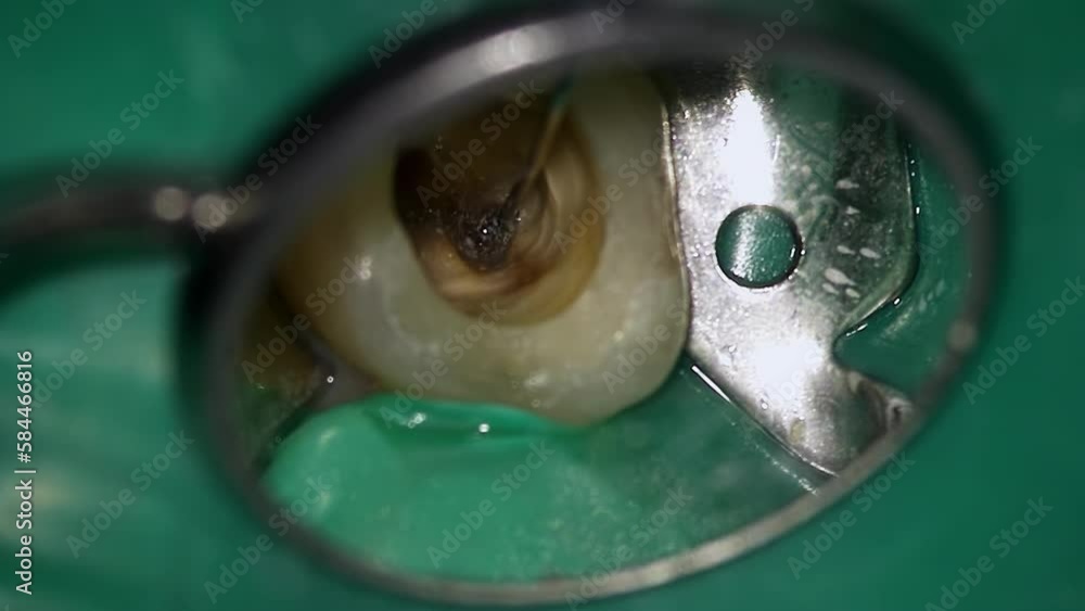 Treatment of tooth decay with the help of professional equipment in a ...