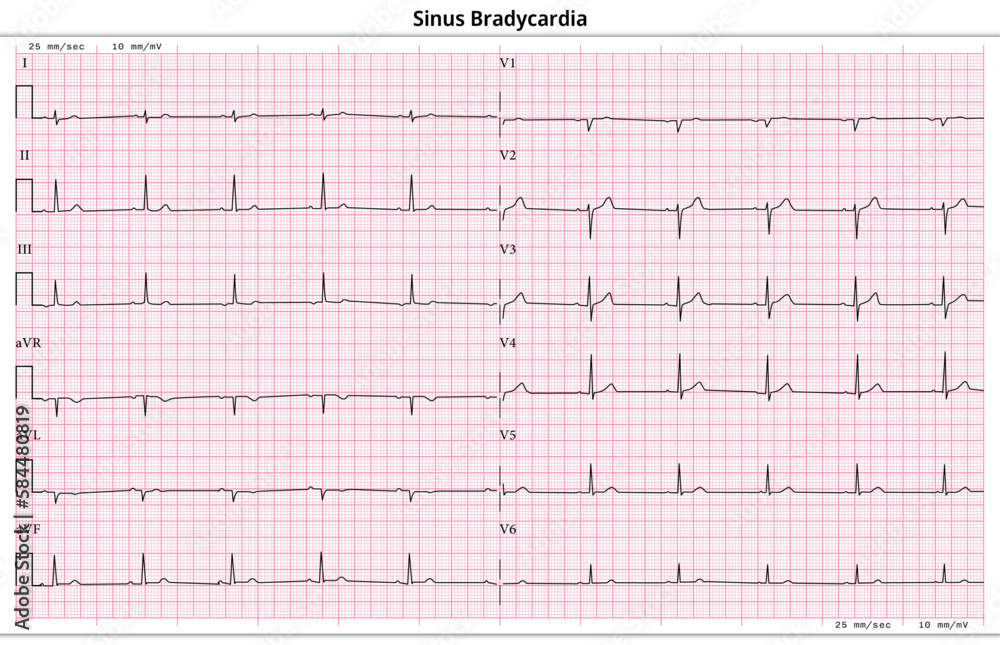 Fotografía ECG Sinus Bradycardia - 12 Lead ECG Common Case - 6 Sec/lead ...