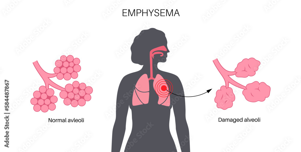 Emphysema anatomical poster Stock Vector | Adobe Stock