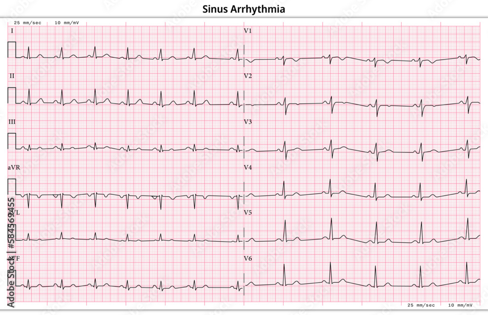 ECG Sinus Arrhythmia - 12 Lead ECG Common Case - 6 Sec/lead - Vector ...