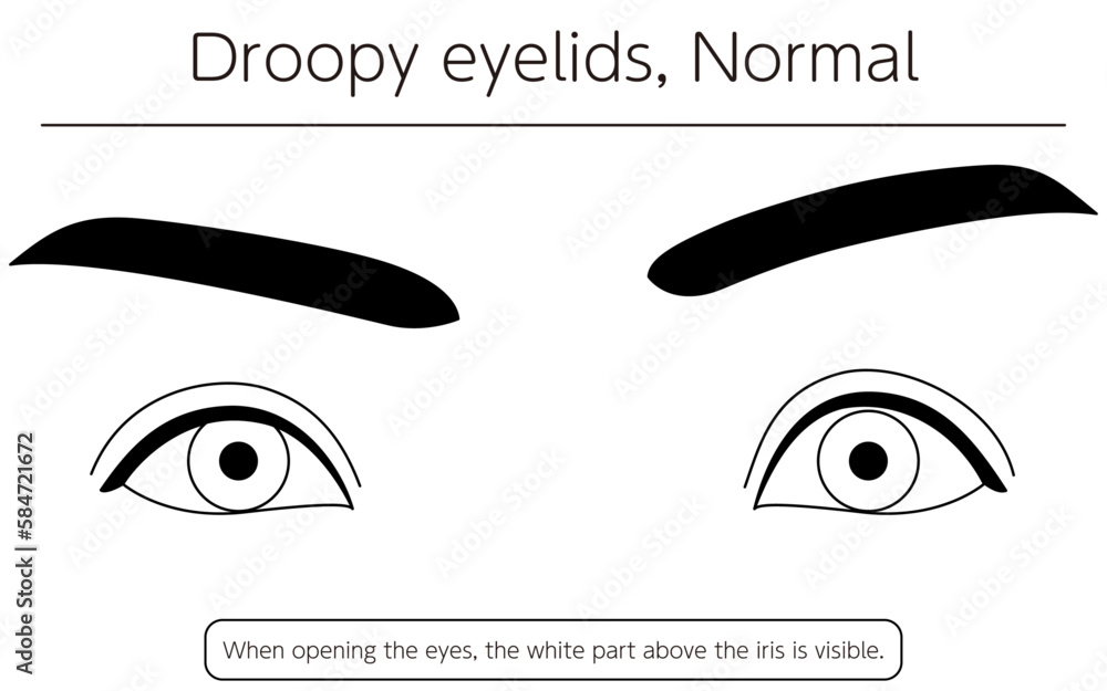 Poster Medical illustration: Diagram of normal state of ptosis (eyelid ...