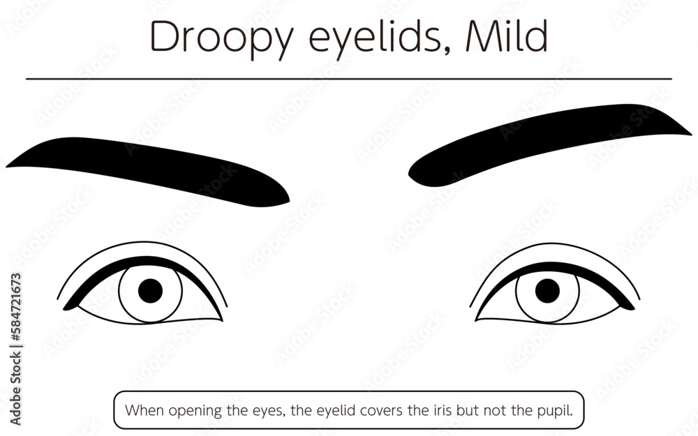Medical illustration: Diagram of mild ptosis (eyelid drooping) Stock ...